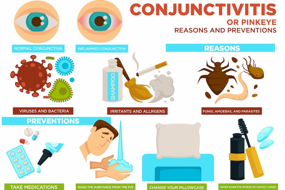 Viral Conjunctivitis - What it is and How to Treat it. - SCALAR LIGHT